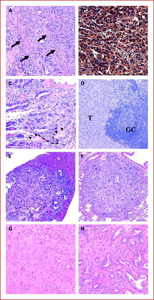 Development of an Orthotopic Model of Invasive Pancreatic Cancer in an ...