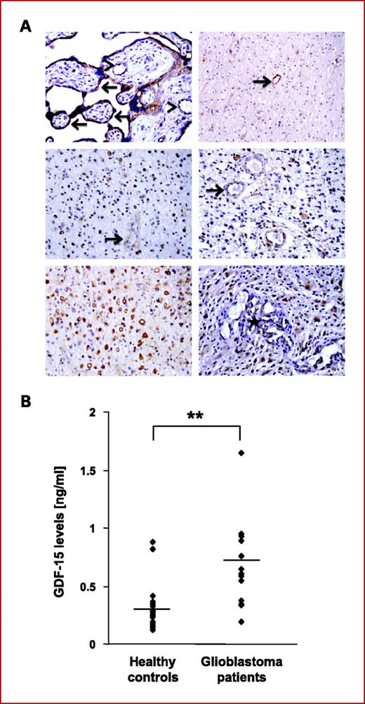 GDF-15 Contributes to Proliferation and Immune Escape of Malignant ...