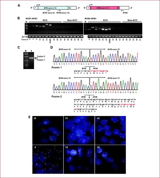 Comprehensive Analysis of the MYB-NFIB Gene Fusion in Salivary Adenoid ...
