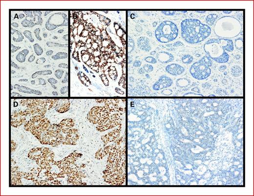 Comprehensive Analysis of the MYB-NFIB Gene Fusion in Salivary Adenoid ...