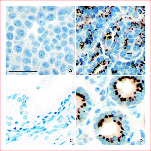 Development of Immunohistochemistry Assays to Assess GALNT14 and FUT3/6 ...