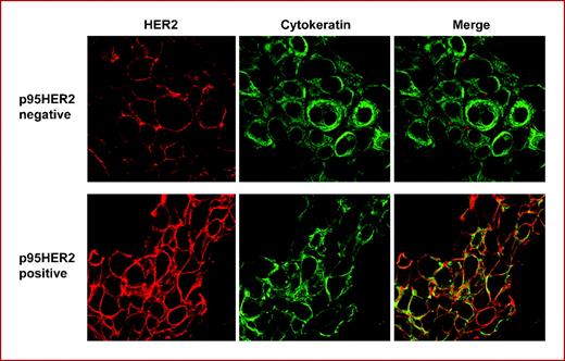 Clinical Benefit of Lapatinib-Based Therapy in Patients with Human ...