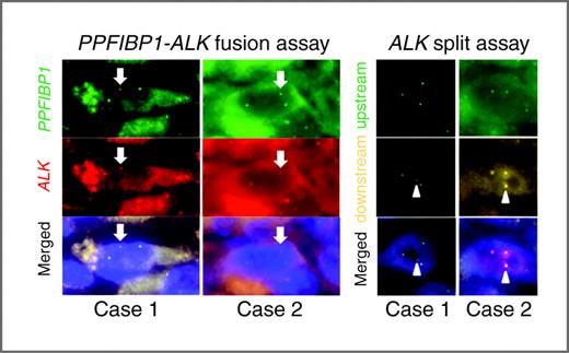 Pulmonary Inflammatory Myofibroblastic Tumor Expressing a Novel Fusion ...