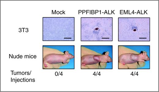 Pulmonary Inflammatory Myofibroblastic Tumor Expressing a Novel Fusion ...