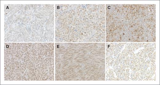 KIT Pathway Alterations in Mucosal Melanomas of the Vulva and Other ...