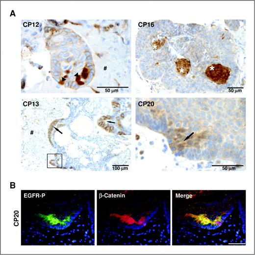 EGFR Signaling Regulates Tumor Cell Migration in Craniopharyngiomas ...
