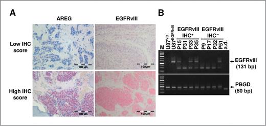 Expression of Amphiregulin and EGFRvIII Affect Outcome of Patients with ...