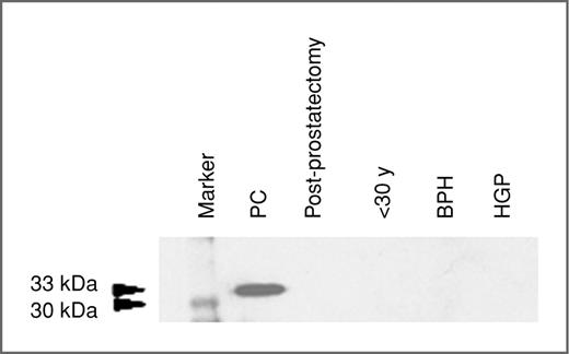 Engrailed-2 (EN2): A Tumor Specific Urinary Biomarker for the Early ...
