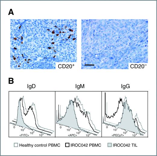 CD20+ Tumor-Infiltrating Lymphocytes Have an Atypical CD27− Memory ...