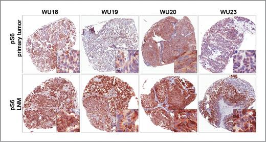 Activation of the mTOR Pathway in Primary Medullary Thyroid Carcinoma ...