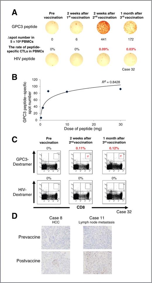 Phase I Trial of a Glypican-3–Derived Peptide Vaccine for Advanced Hepatocellular Carcinoma ...