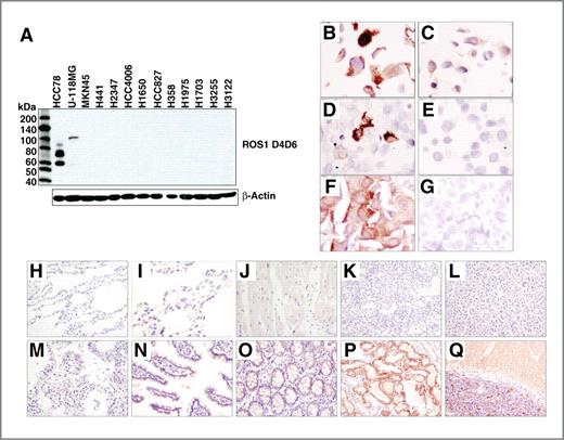 Analysis of Receptor Tyrosine Kinase ROS1-Positive Tumors in Non–Small ...