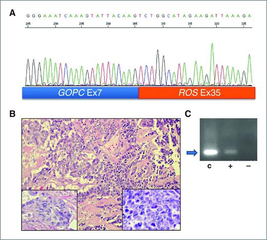 Identification of KIF5B-RET and GOPC-ROS1 Fusions in Lung ...