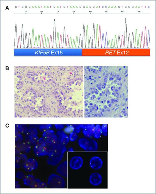 Identification of KIF5B-RET and GOPC-ROS1 Fusions in Lung ...