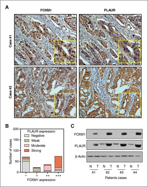 The Critical Role of Dysregulated FOXM1–PLAUR Signaling in Human Colon ...