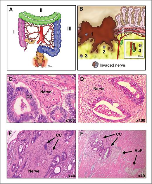 The Severity of Neural Invasion Is Associated with Shortened Survival ...