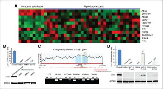 ASS1 as a Novel Tumor Suppressor Gene in Myxofibrosarcomas: Aberrant ...