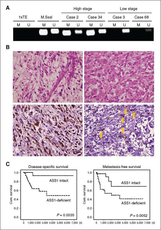 ASS1 as a Novel Tumor Suppressor Gene in Myxofibrosarcomas: Aberrant ...