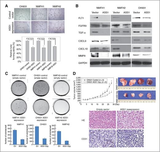ASS1 as a Novel Tumor Suppressor Gene in Myxofibrosarcomas: Aberrant ...