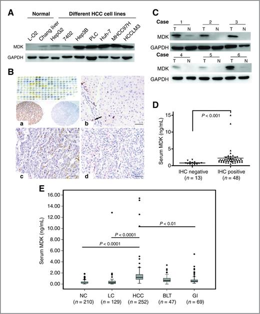 Evaluation of Midkine as a Diagnostic Serum Biomarker in Hepatocellular ...