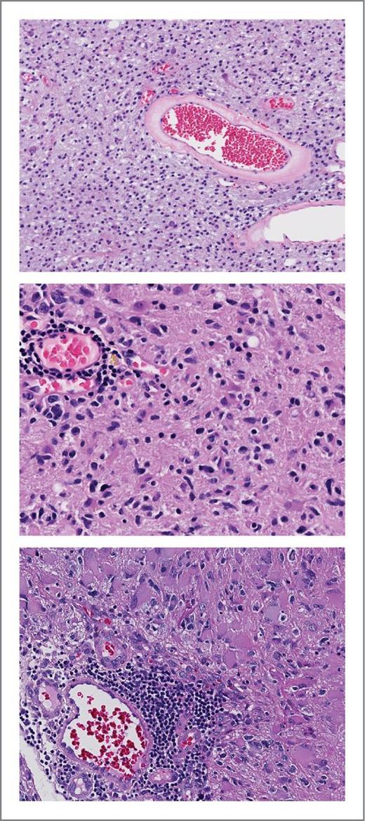 Tumor-Infiltrating Lymphocytes in Glioblastoma Are Associated with ...