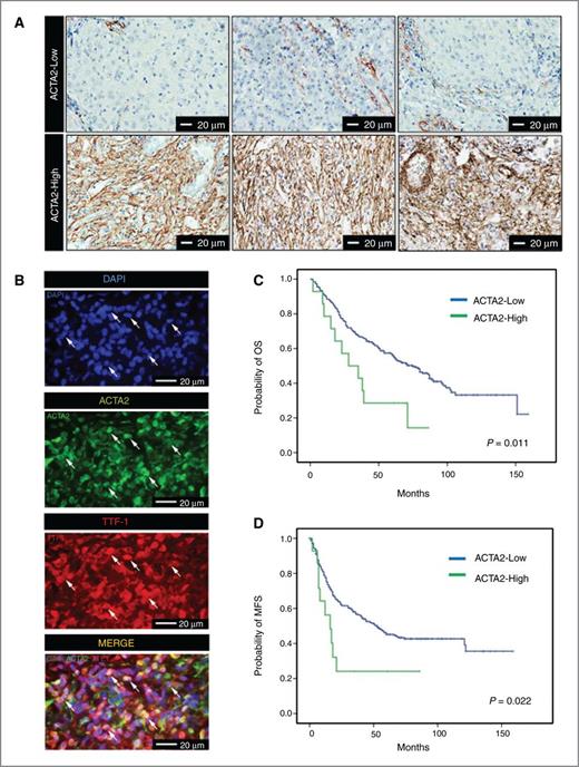 Alpha-Smooth Muscle Actin (ACTA2) Is Required for Metastatic Potential ...