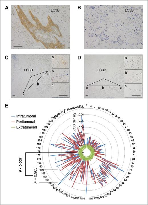 The Residual Tumor Autophagy Marker LC3B Serves as a Prognostic Marker ...