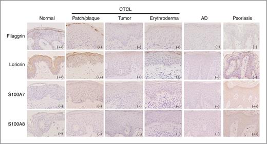 Skin Barrier Dysfunction and Low Antimicrobial Peptide Expression in ...