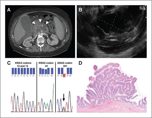 Preoperative GNAS and KRAS Testing in the Diagnosis of Pancreatic ...