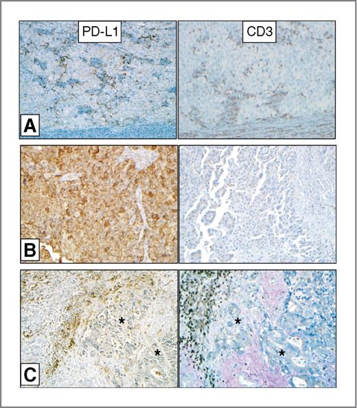 Association of PD-1, PD-1 Ligands, and Other Features of the Tumor ...