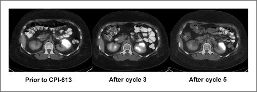 A Phase I Study of the First-in-Class Antimitochondrial Metabolism ...