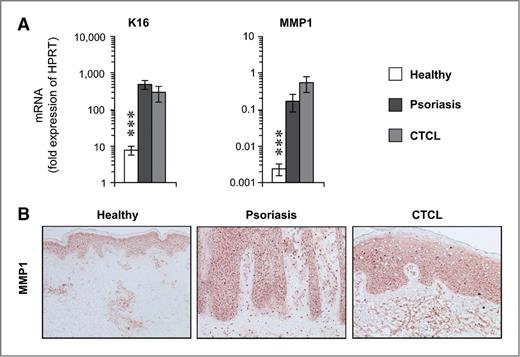 Deficient Cutaneous Antibacterial Competence in Cutaneous T-Cell ...