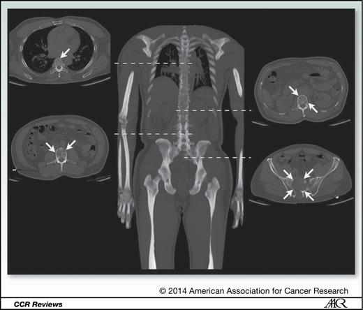 Whole-Body Low-Dose Computed Tomography and Advanced Imaging Techniques ...