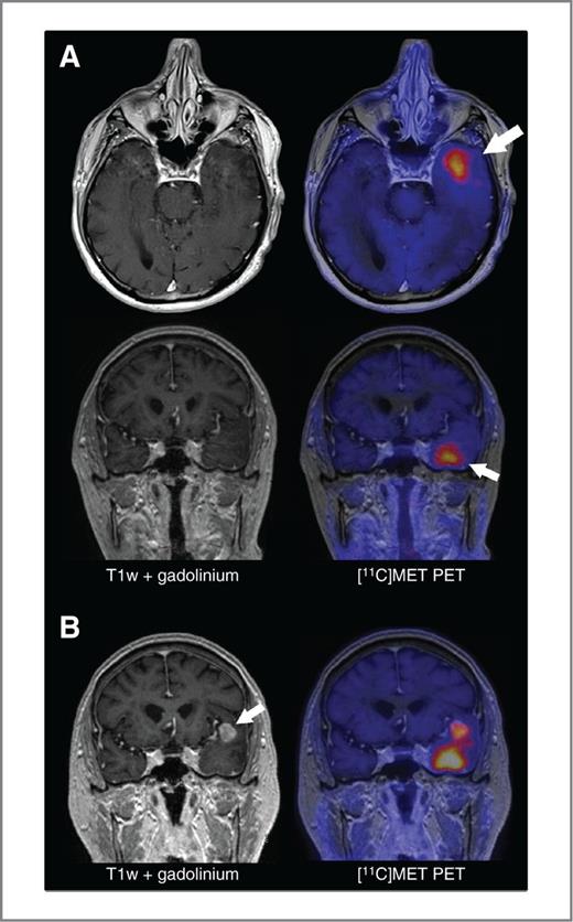 Definition of Primary and Secondary Glioblastoma—Letter | Clinical ...