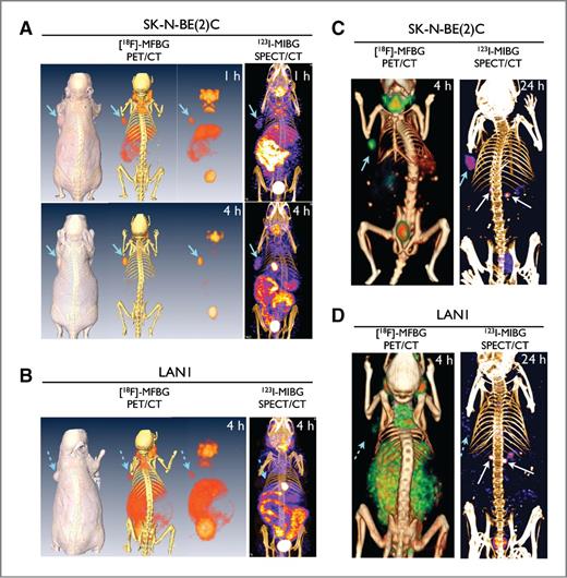 Imaging the Norepinephrine Transporter in Neuroblastoma: A Comparison ...