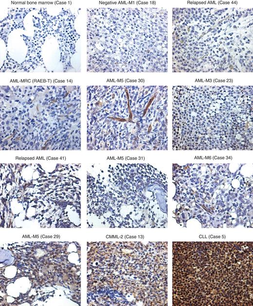Targeting IL11 Receptor in Leukemia and Lymphoma: A Functional Ligand ...