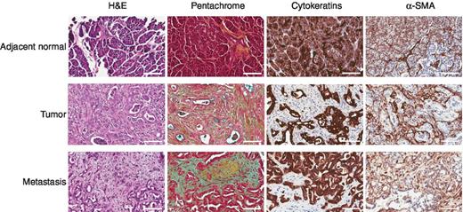 Desmoplasia in Primary Tumors and Metastatic Lesions of Pancreatic ...