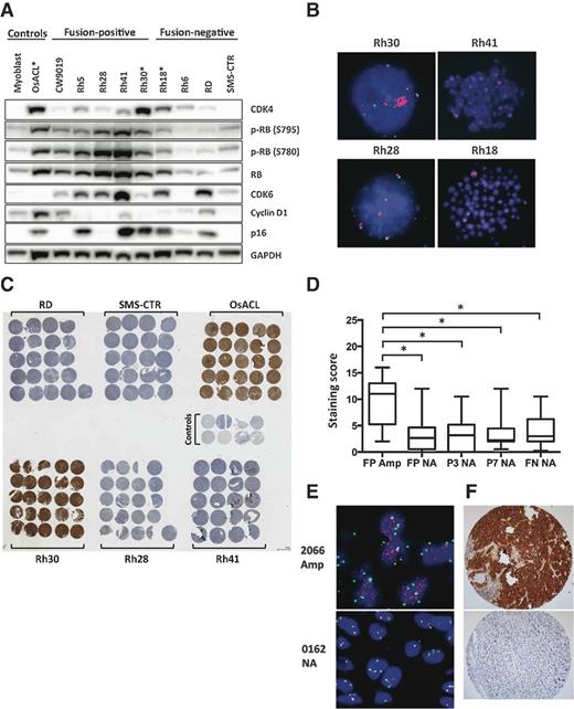 CDK4 Amplification Reduces Sensitivity to CDK4/6 Inhibition in Fusion ...