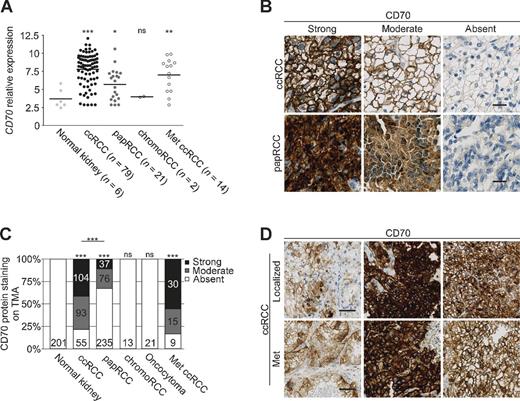 pVHL/HIF-Regulated CD70 Expression Is Associated with Infiltration of ...