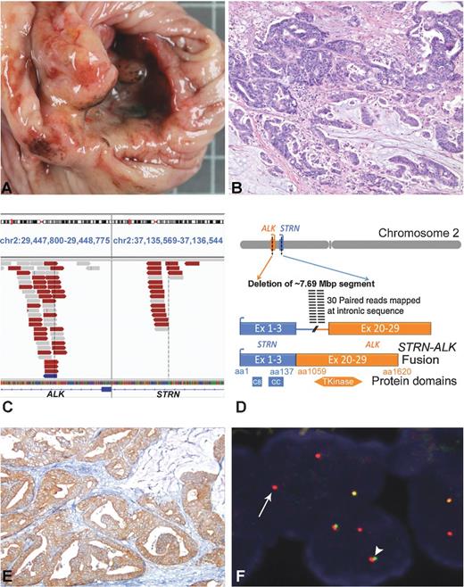 Oncogenic ALK Fusion in Rare and Aggressive Subtype of Colorectal ...