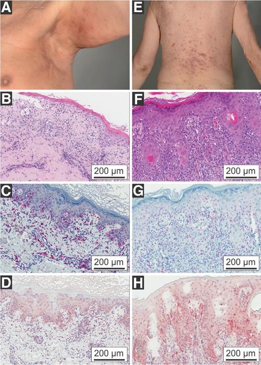 Cytotoxic Cutaneous Adverse Drug Reactions during Anti-PD-1 Therapy ...