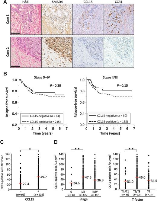 Loss of SMAD4 Promotes Colorectal Cancer Progression by Accumulation of ...