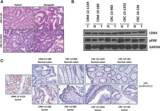 Sensitivity of KRAS-Mutant Colorectal Cancers to Combination Therapy ...