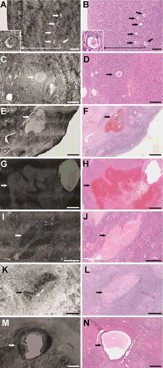 Noninvasive Detection of Metastases and Follicle Density in Ovarian ...