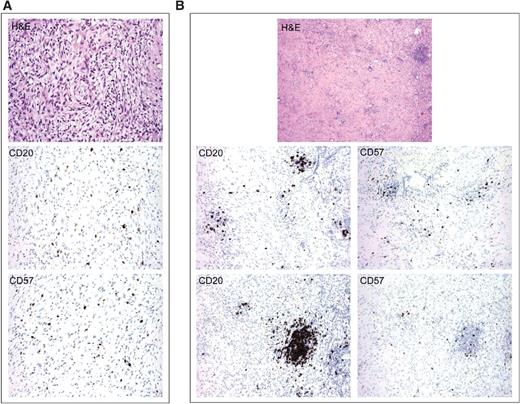 Efficacy and Biological Activity of Imatinib in Metastatic ...