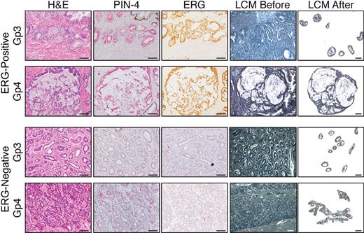 Gleason Score 7 Prostate Cancers Emerge through Branched Evolution of ...