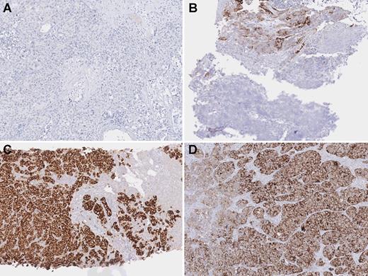 Dichotomous ALK-IHC Is a Better Predictor for ALK Inhibition Outcome ...