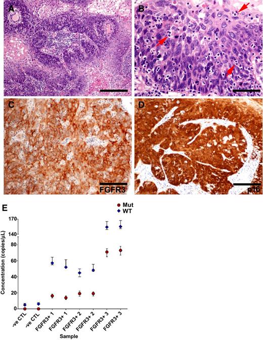 Vulvar Squamous Cell Carcinoma (VSCC) as Two Diseases: HPV Status ...