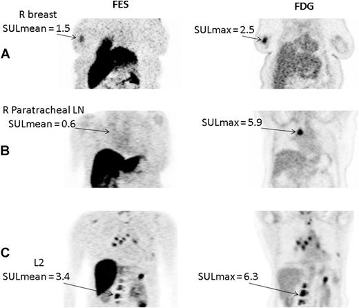 Estrogen Receptor Binding (18F-FES PET) and Glycolytic Activity (18F ...