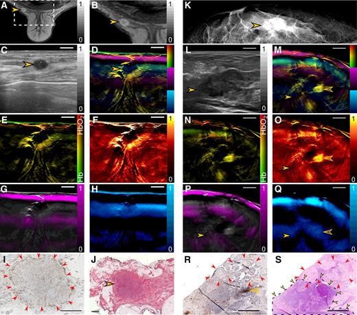 Multispectral Optoacoustic Tomography (MSOT) of Human Breast Cancer ...